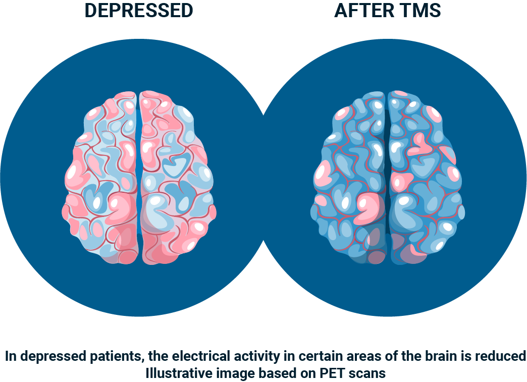 Estimulación Magnética Transcraneal | Psiquiatra Eduardo Vera Barrios